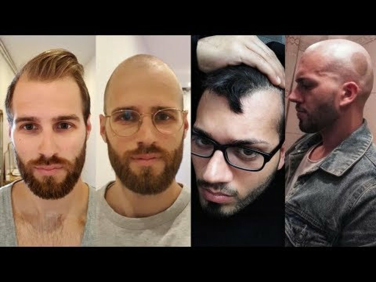 Baldcafe is Helping Men around the world go bravely and confidently bald